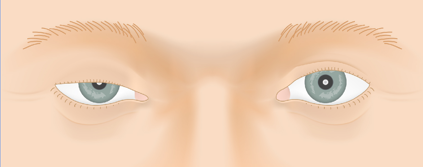 Cartoon Droopy Eyelids And Swollen